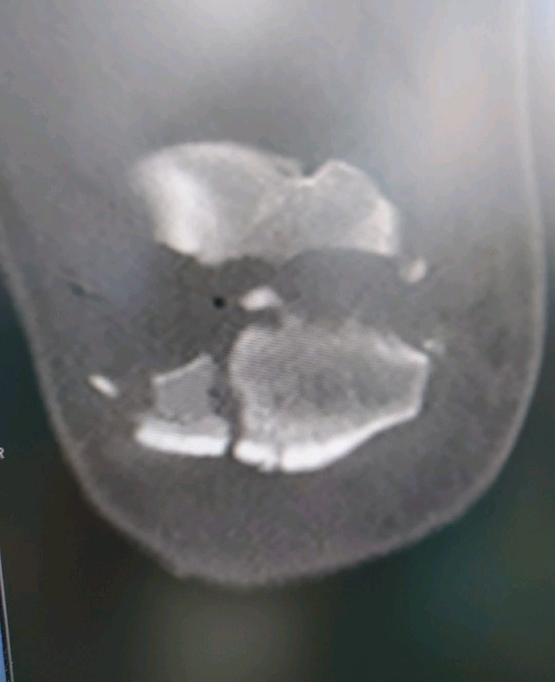 Placa poliaxiala pentru fracturile de Patela (Rotula) – Enlife ...